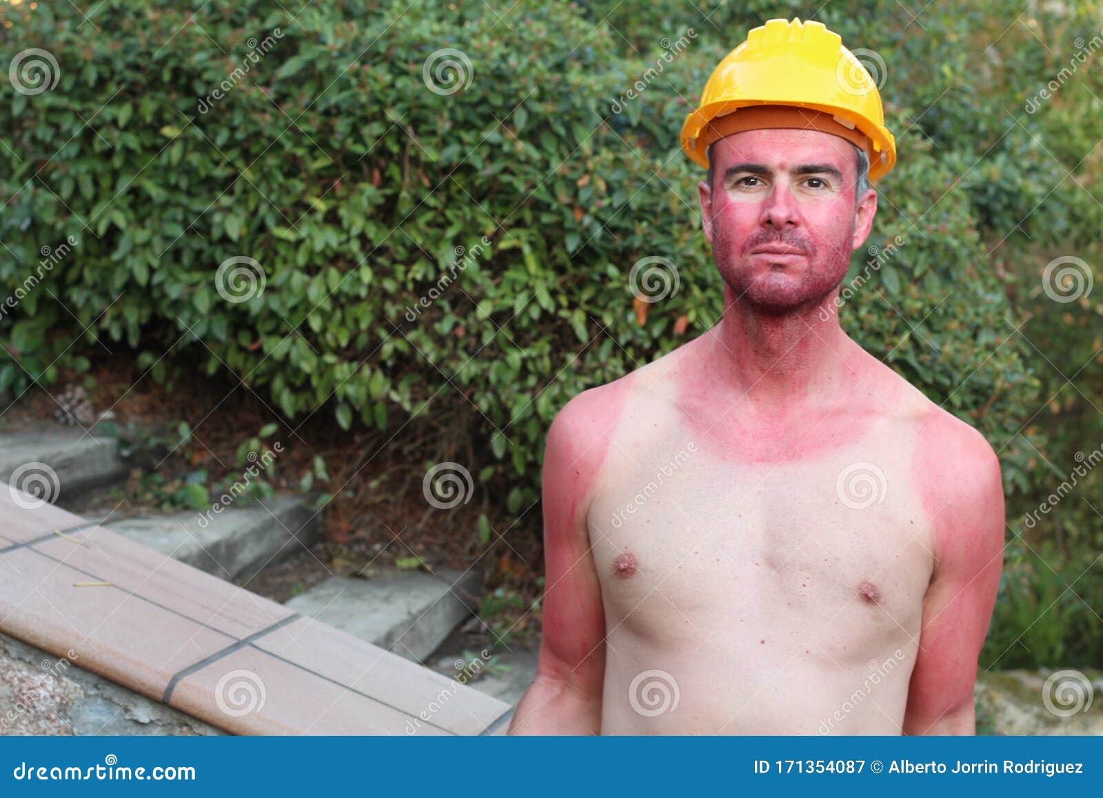 Sunburned Construction Worker with Extreme Tan Lines Stock Image ...