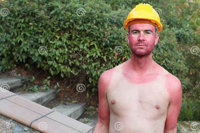 Sunburned Construction Worker with Extreme Tan Lines Stock Image ...
