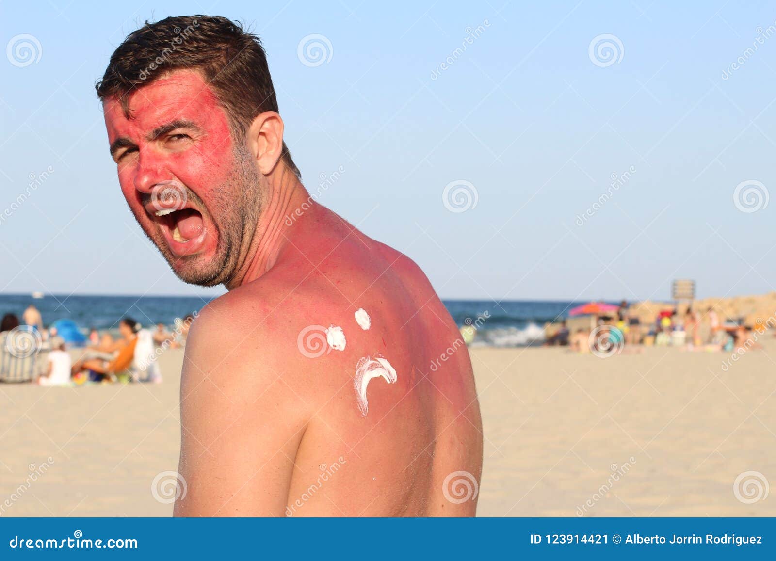 Sunburned Man with Lots of Pain Stock Image - Image of isolated, burn ...
