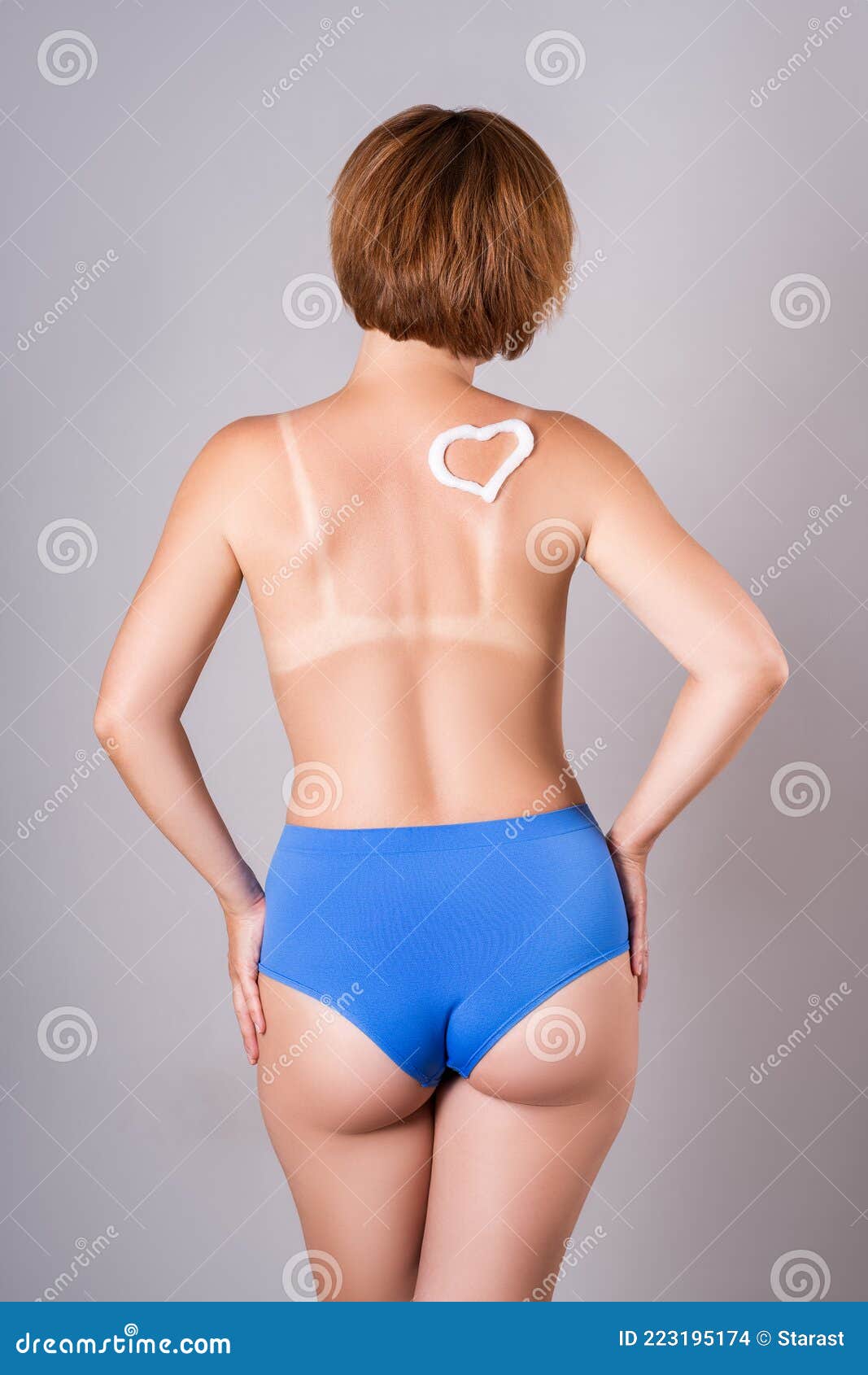 Sunburned Woman Sunburn Marks On The Body Heart Shaped Sunscreen On