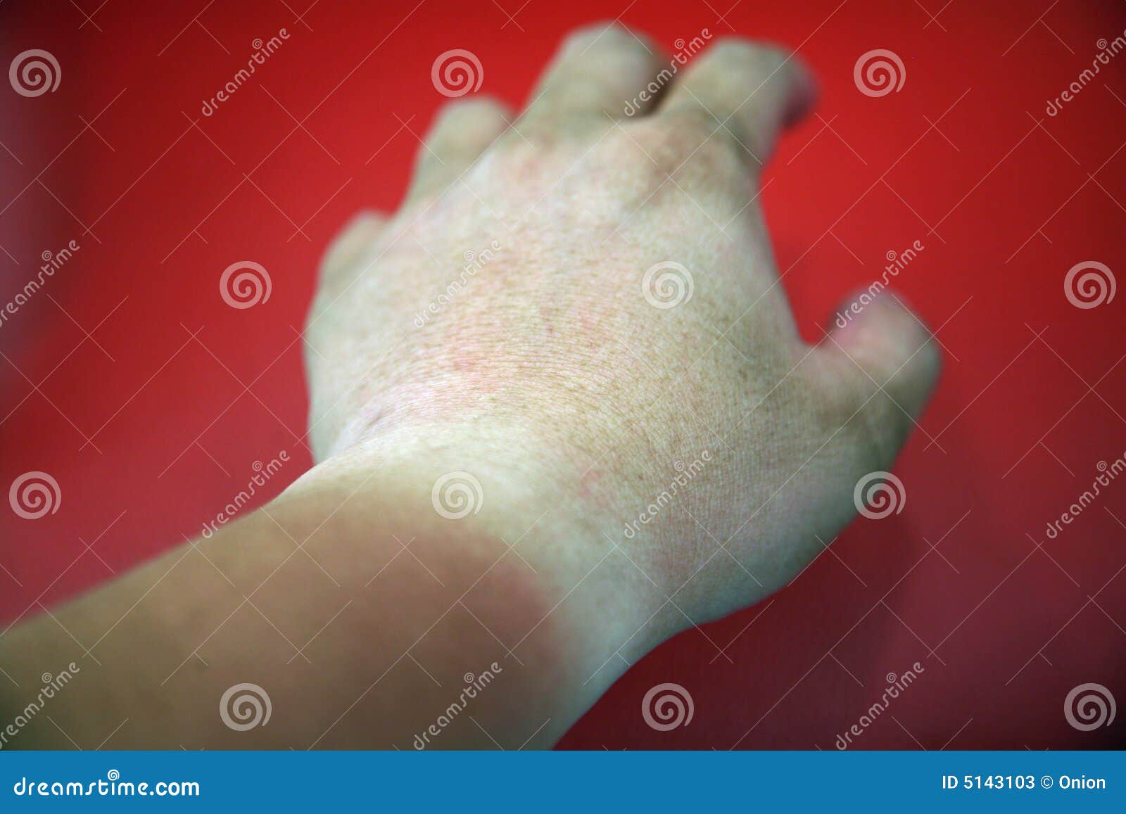 Sunburnt On Skin Around Knee Of Man`s Left Leg Stock Image
