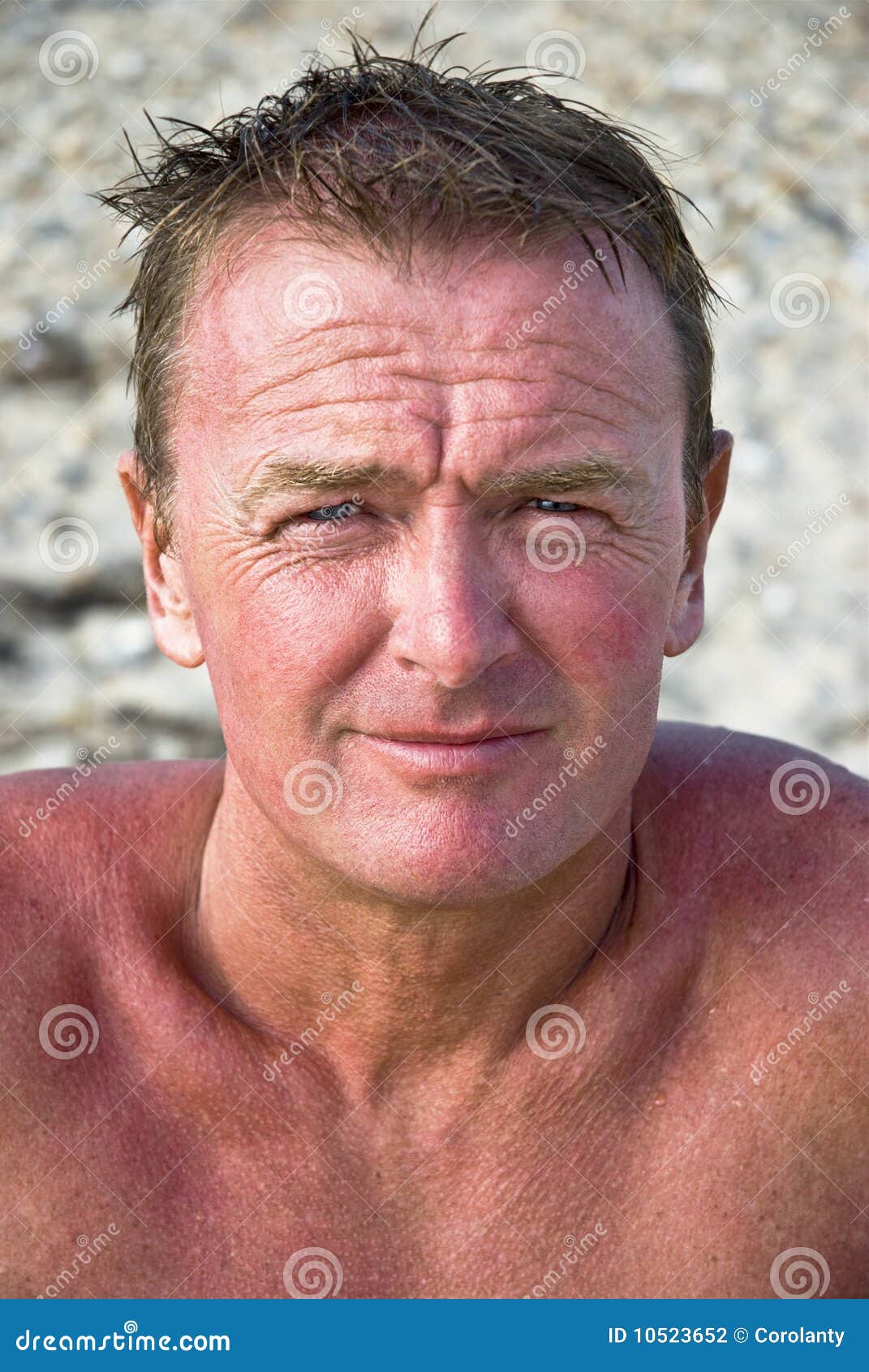 Sunburnt man. stock photo. Image of handsome, damage - 10523652
