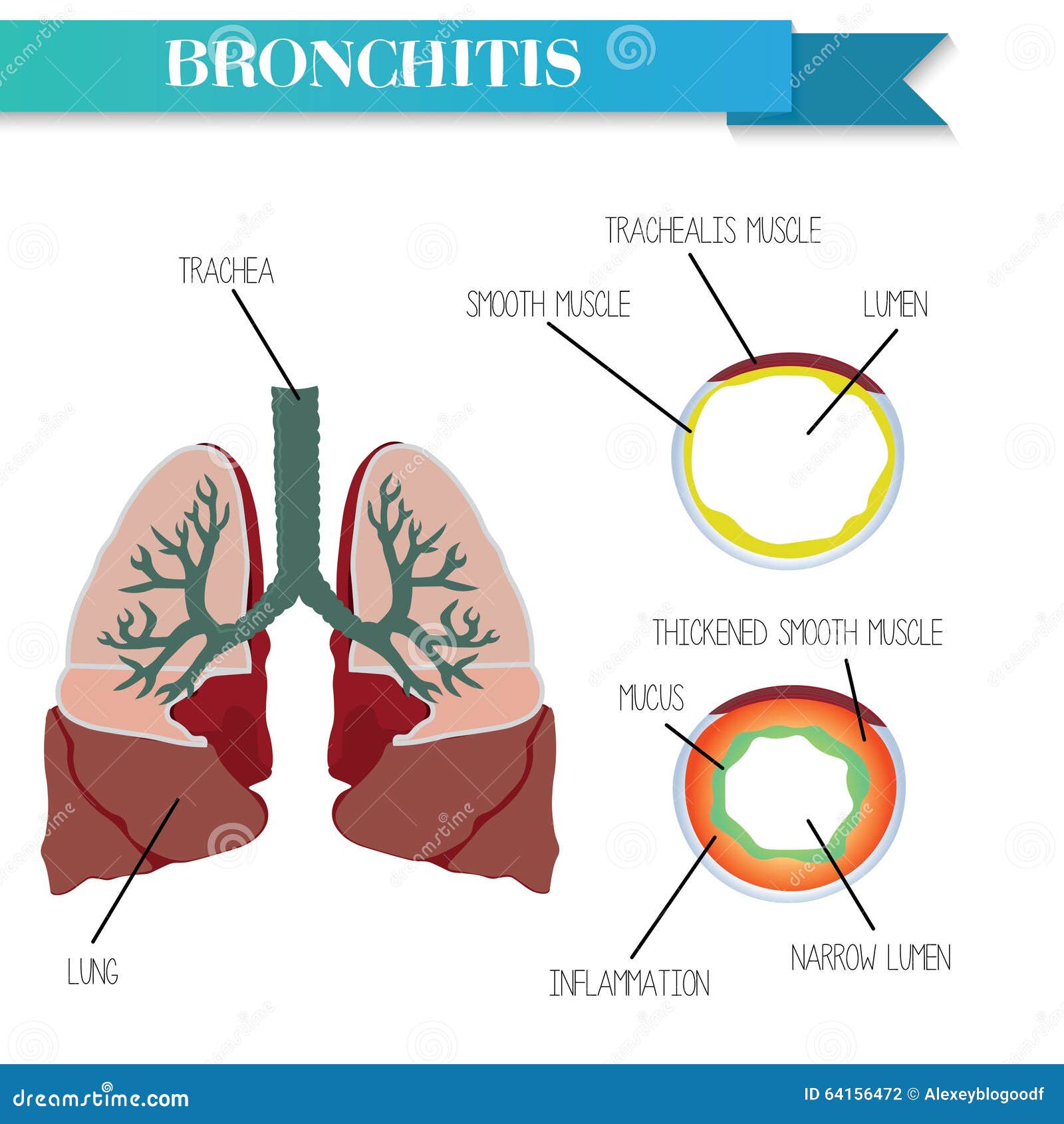 Sund Och Inflammerad Bronchus Kronisk Bronkit Vektor Illustrationer ...