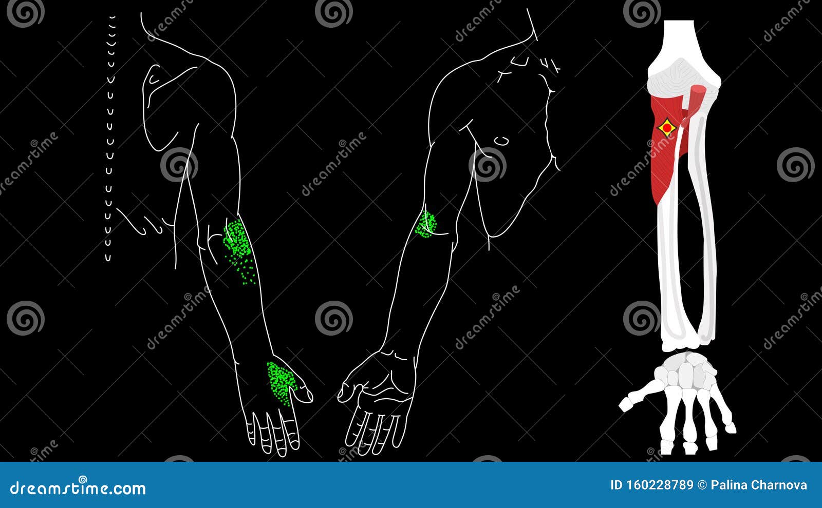 Supinator Muscle. Trigger Points in the Muscles of the Hands. Stock ...