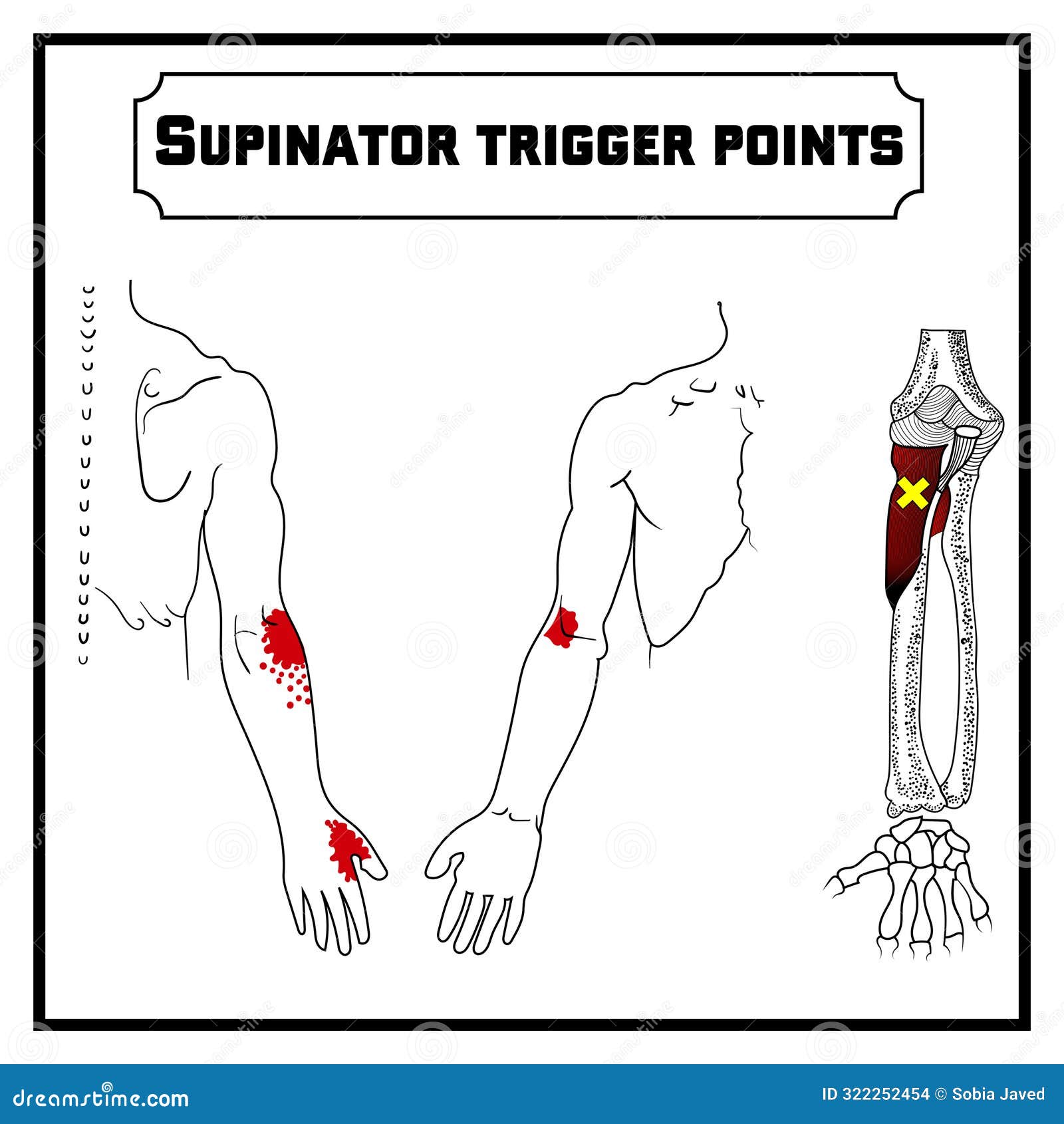Supinator Trigger Points Vector Diagram Editable Stock Vector ...