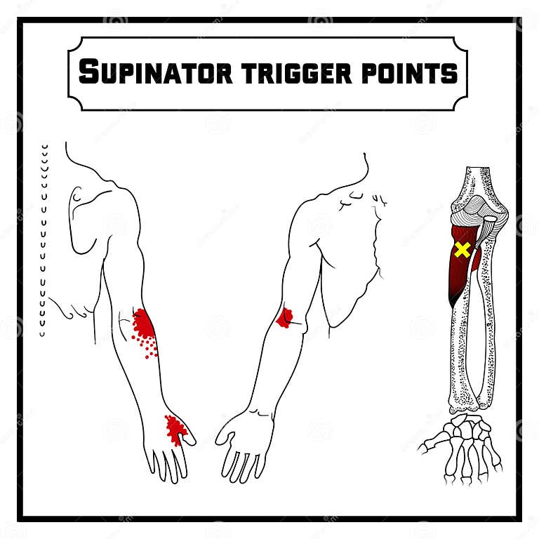 Supinator Trigger Points Vector Diagram Editable Stock Vector ...