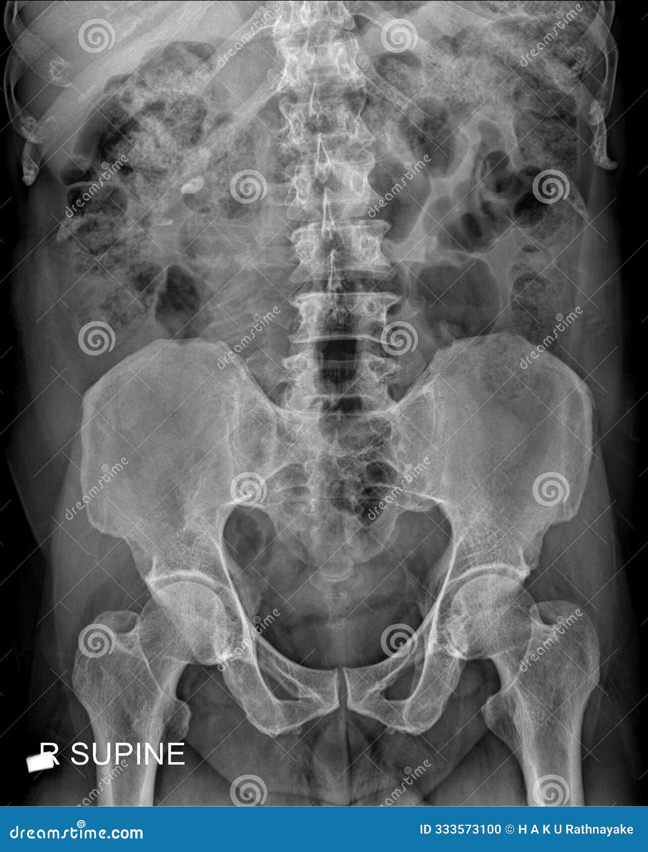 Supine Abdominal X-ray for Diagnostic Imaging Stock Photo - Image of ...
