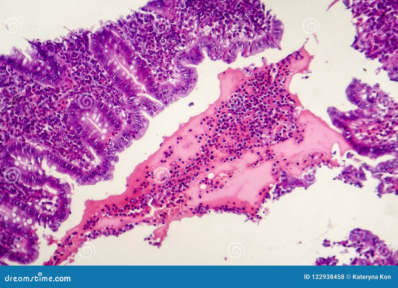 Suppurative Appendicitis, Light Micrograph Royalty-Free Stock Photo ...