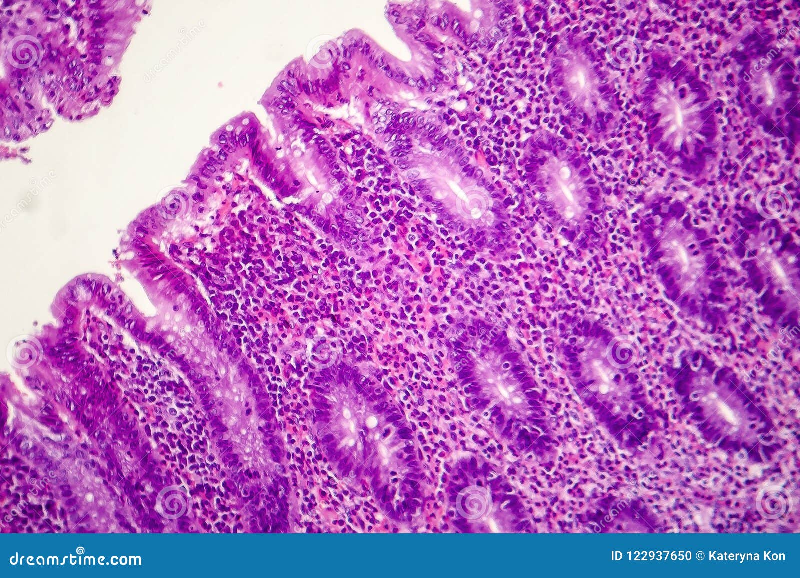 Suppurative Appendicitis, Light Micrograph Stock Photo - Image of ...