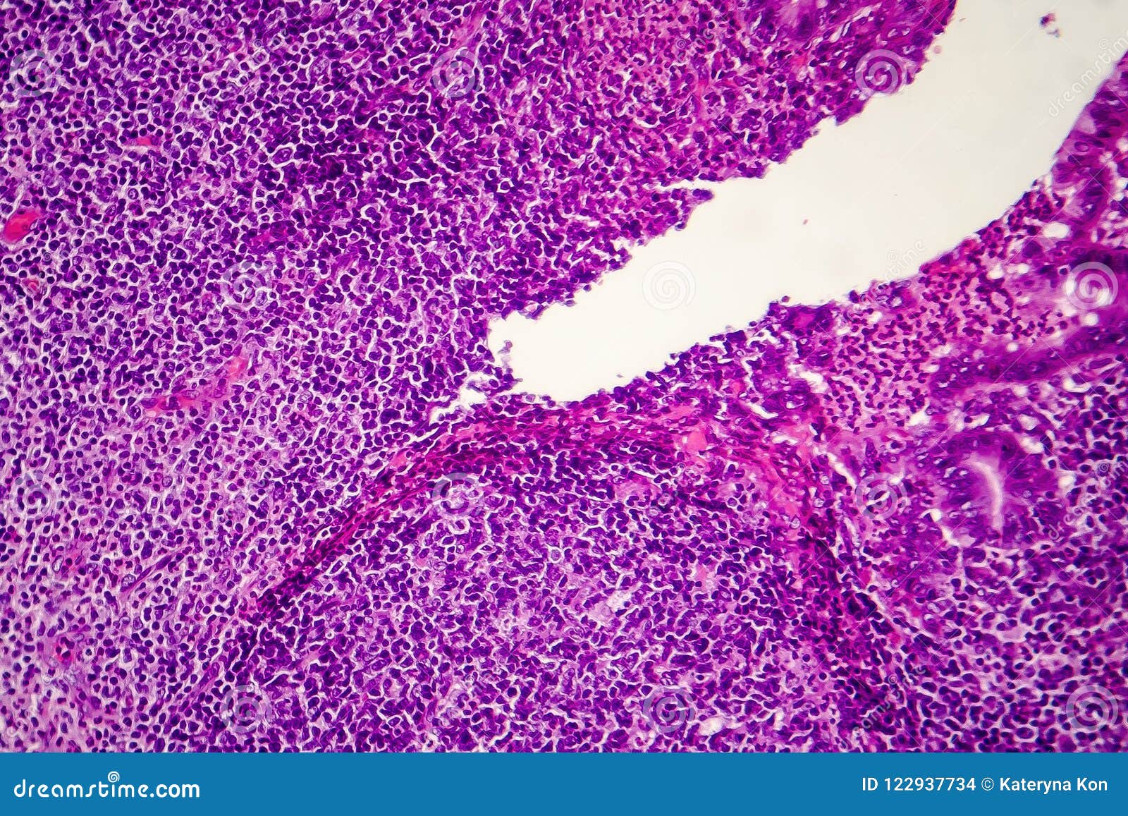 Suppurative Appendicitis, Light Micrograph Stock Photo - Image of ...