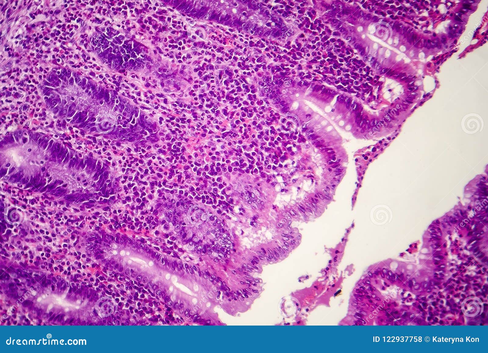 Suppurative Appendicitis, Light Micrograph Stock Photo - Image of ...