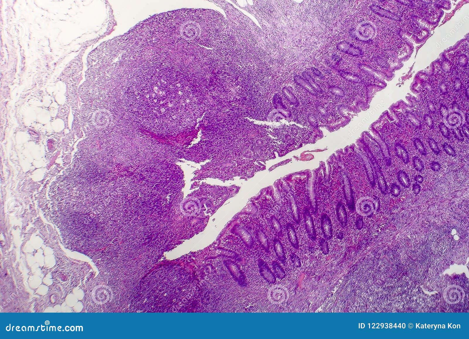 Suppurative Appendicitis, Light Micrograph Stock Photo - Image of ...
