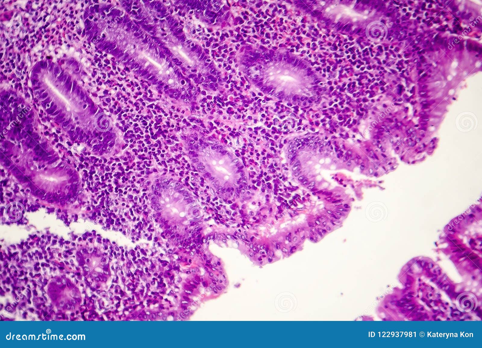 Suppurative Appendicitis, Light Micrograph Stock Image - Image of ...