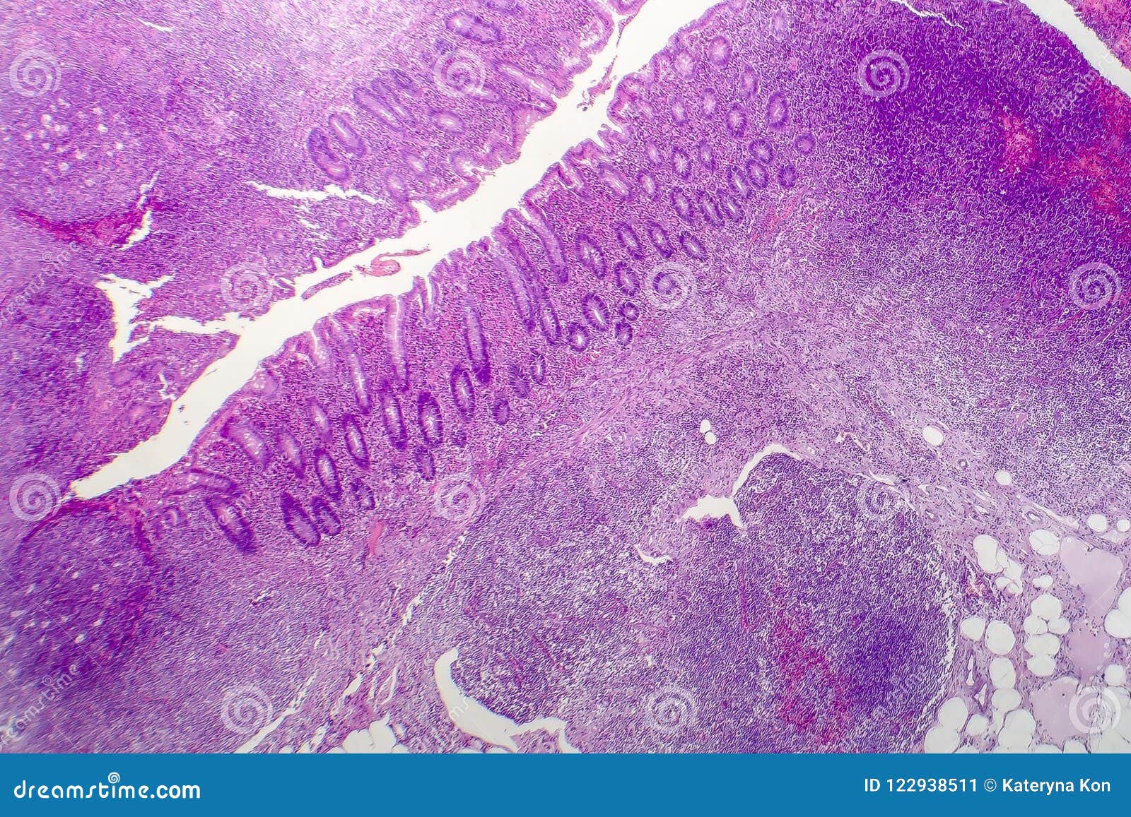 Suppurative Appendicitis, Light Micrograph Stock Image - Image of ...