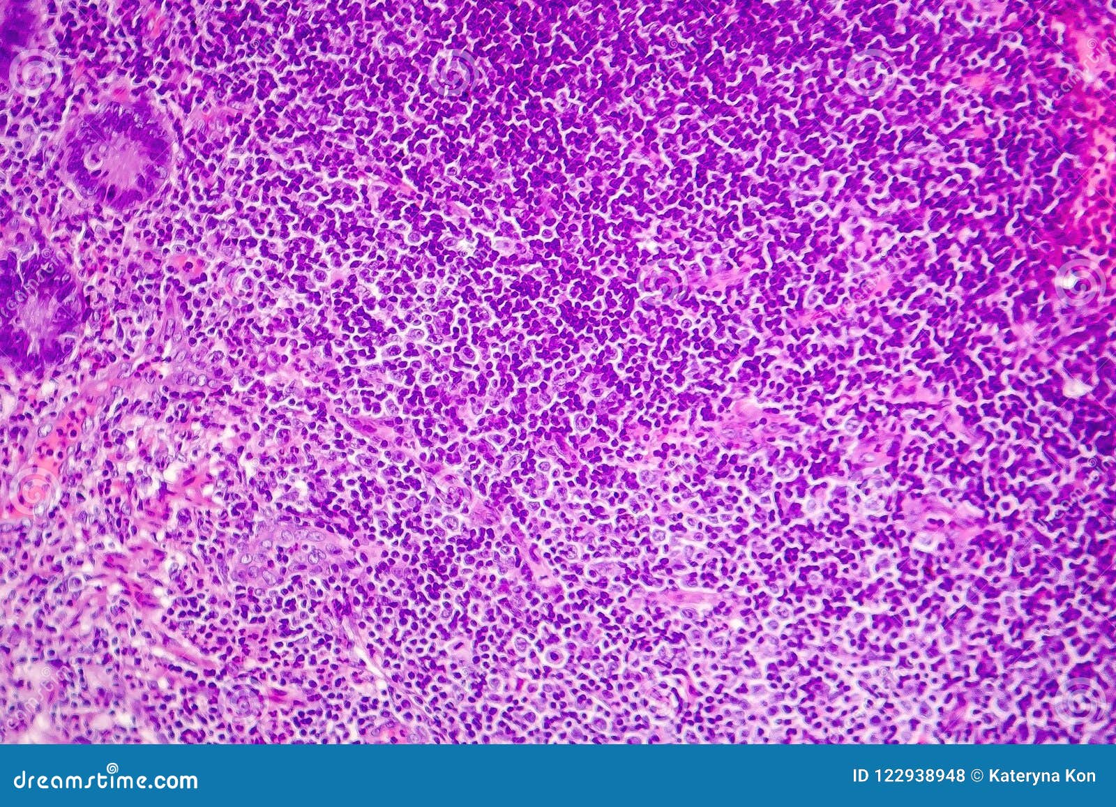 Suppurative Appendicitis, Light Micrograph Stock Photo - Image of micro ...