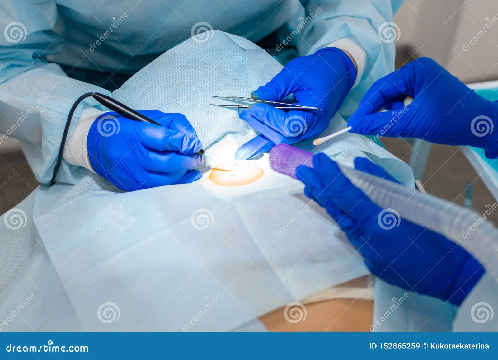 The Surgeon Does Surgery To Remove the Mole on the Patient`s Back. the ...