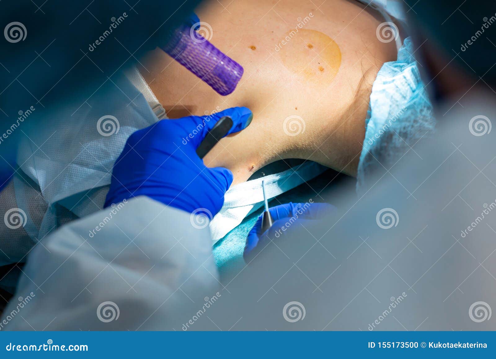 The Surgeon Does Surgery To Remove the Mole on the Patient`s Back. the ...