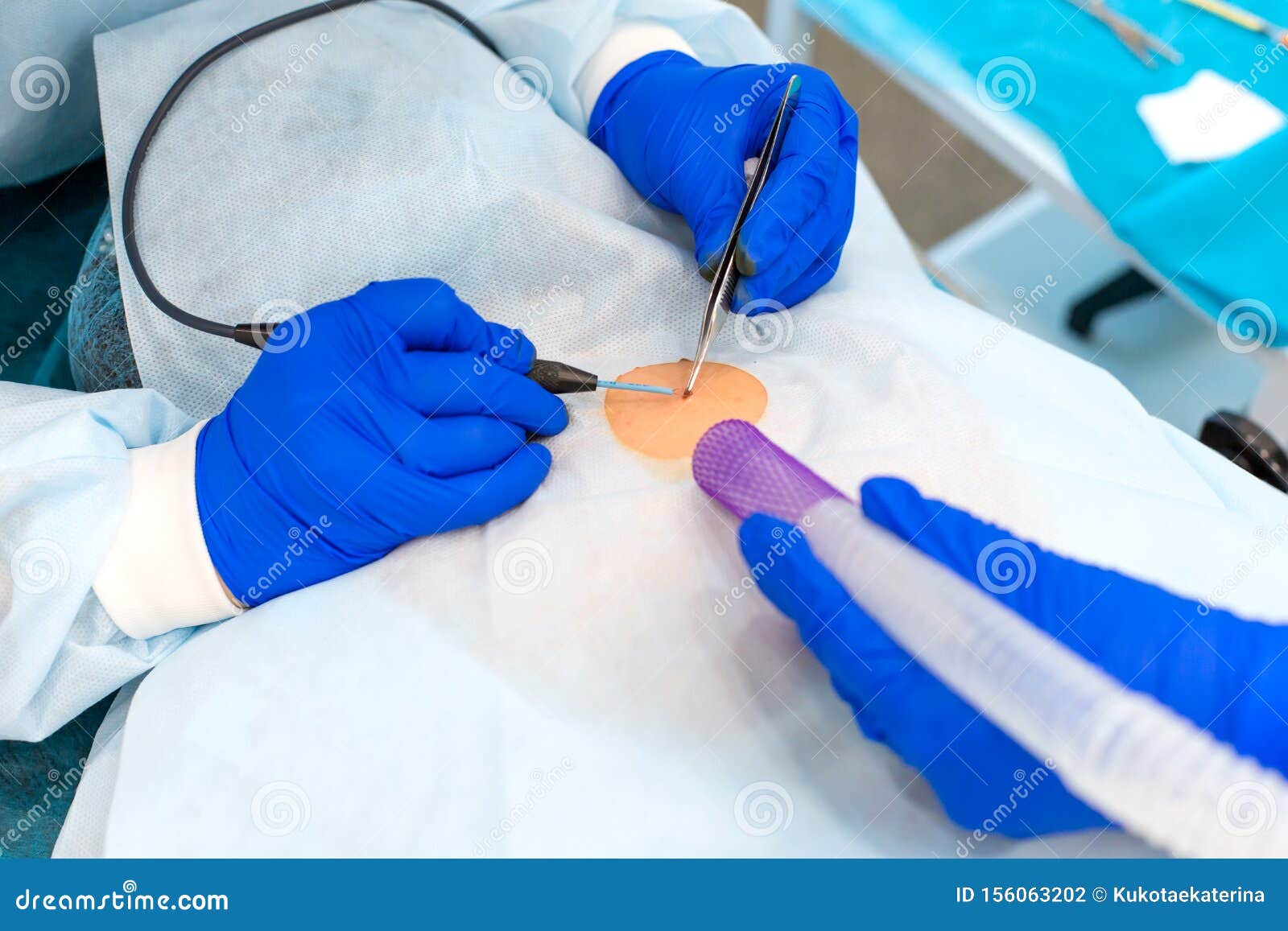 The Surgeon Does Surgery To Remove the Mole on the Patient`s Back. the ...