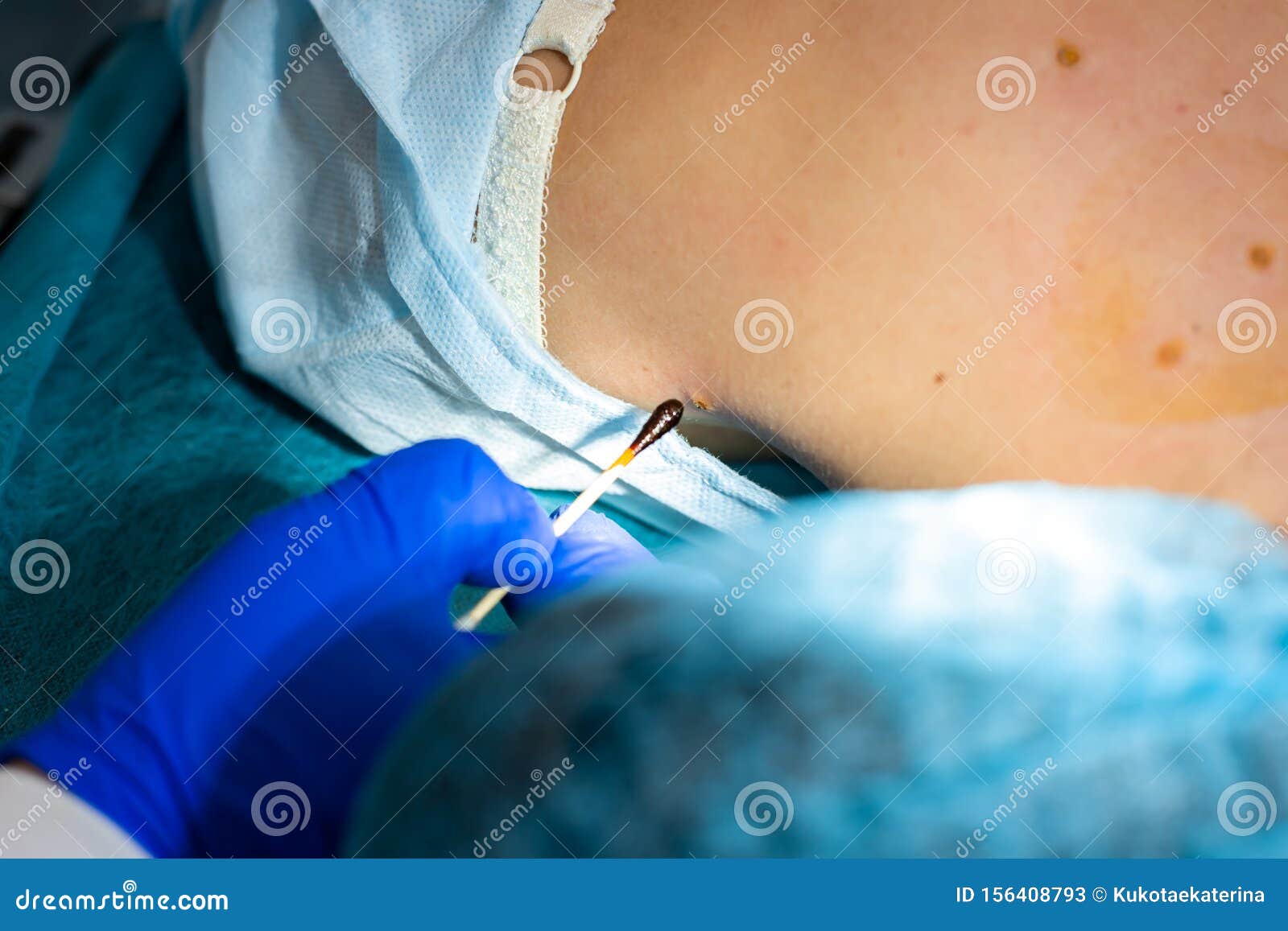 The Surgeon Does Surgery To Remove The Mole On The Patient`s Back. The ...