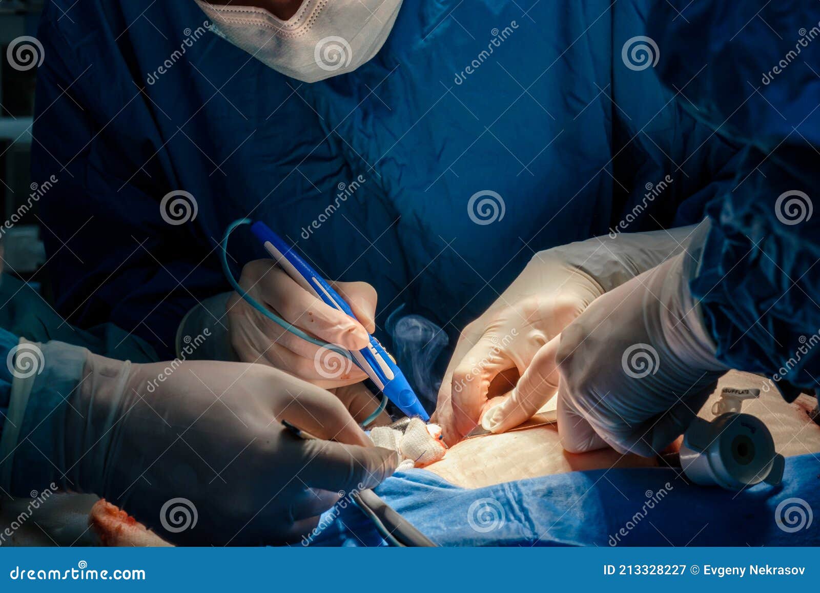The Surgeon Holds the Electrical Coagulator during the Operation Stock ...