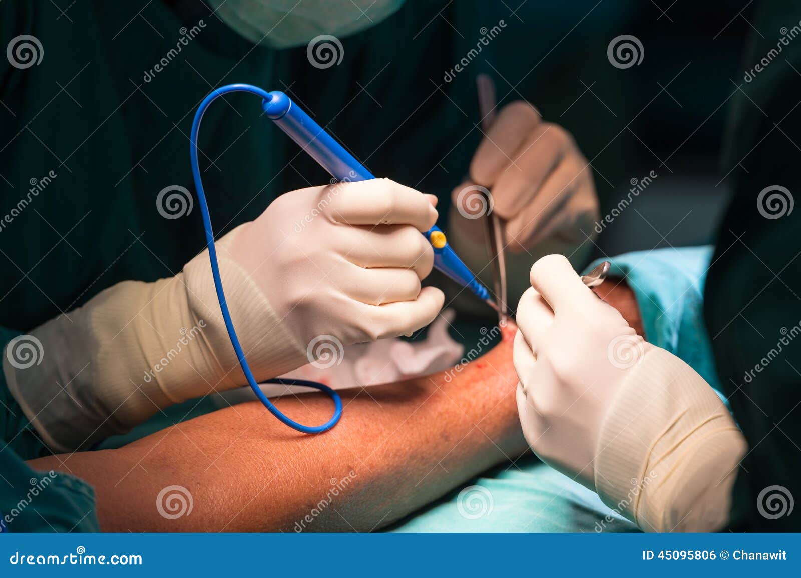 Surgeon make skin incision stock photo. Image of fistula - 45095806