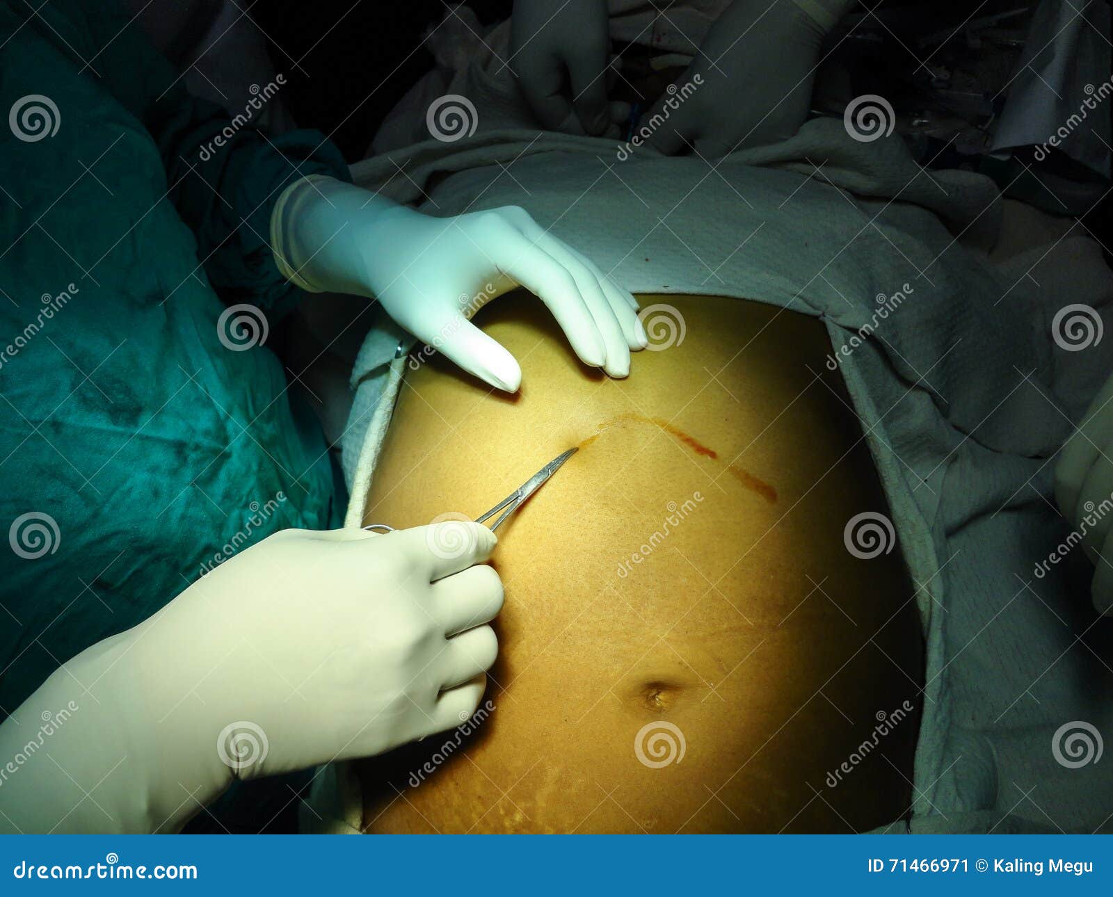 Surgeon Performing Operation in OT Room Stock Image - Image of ...