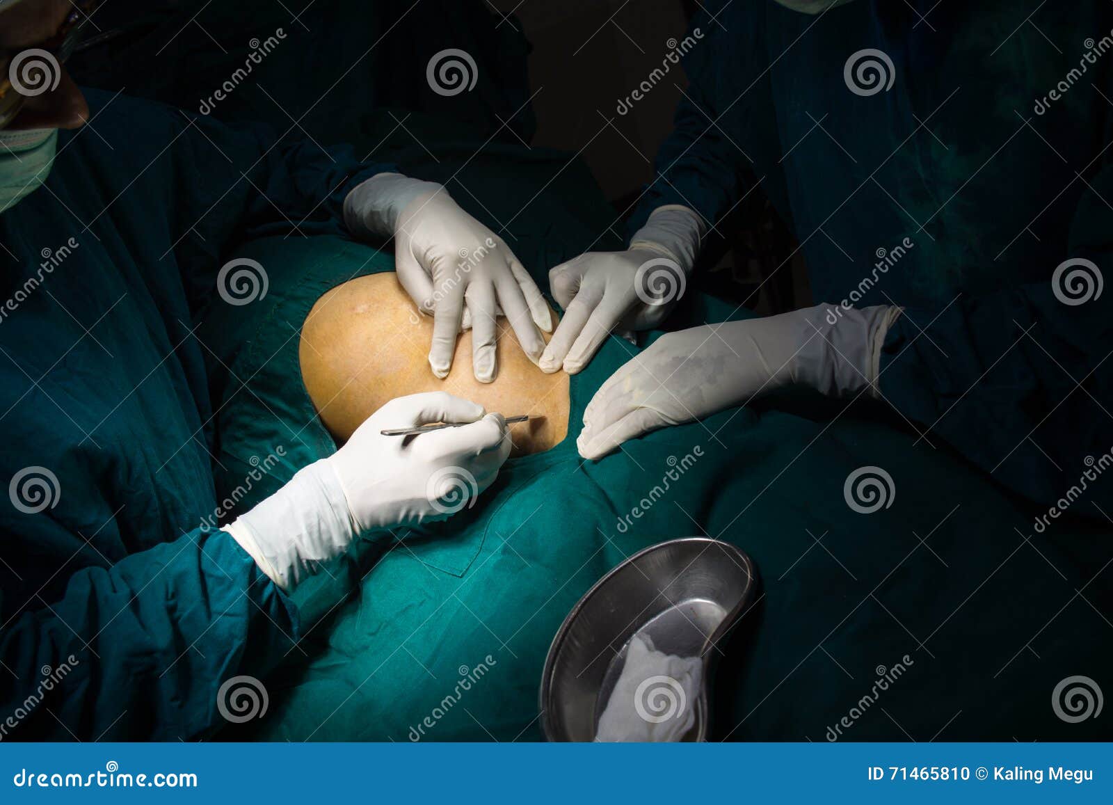 Surgeon Performing Operation in OT Room Stock Photo - Image of thigh ...