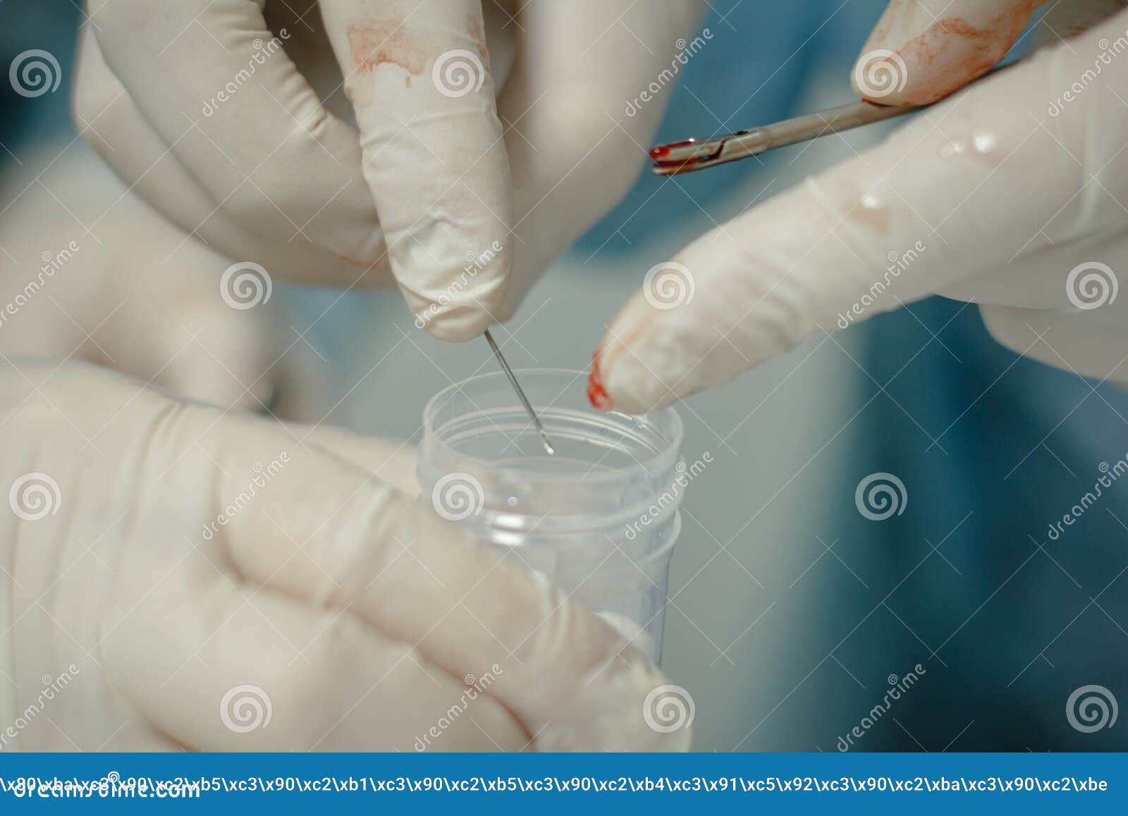The Surgeon Puts the Biopsy Material into a Container with a Farmalin ...