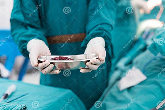 Surgeon Show Lung Specimen after Surgery Stock Photo - Image of glove ...