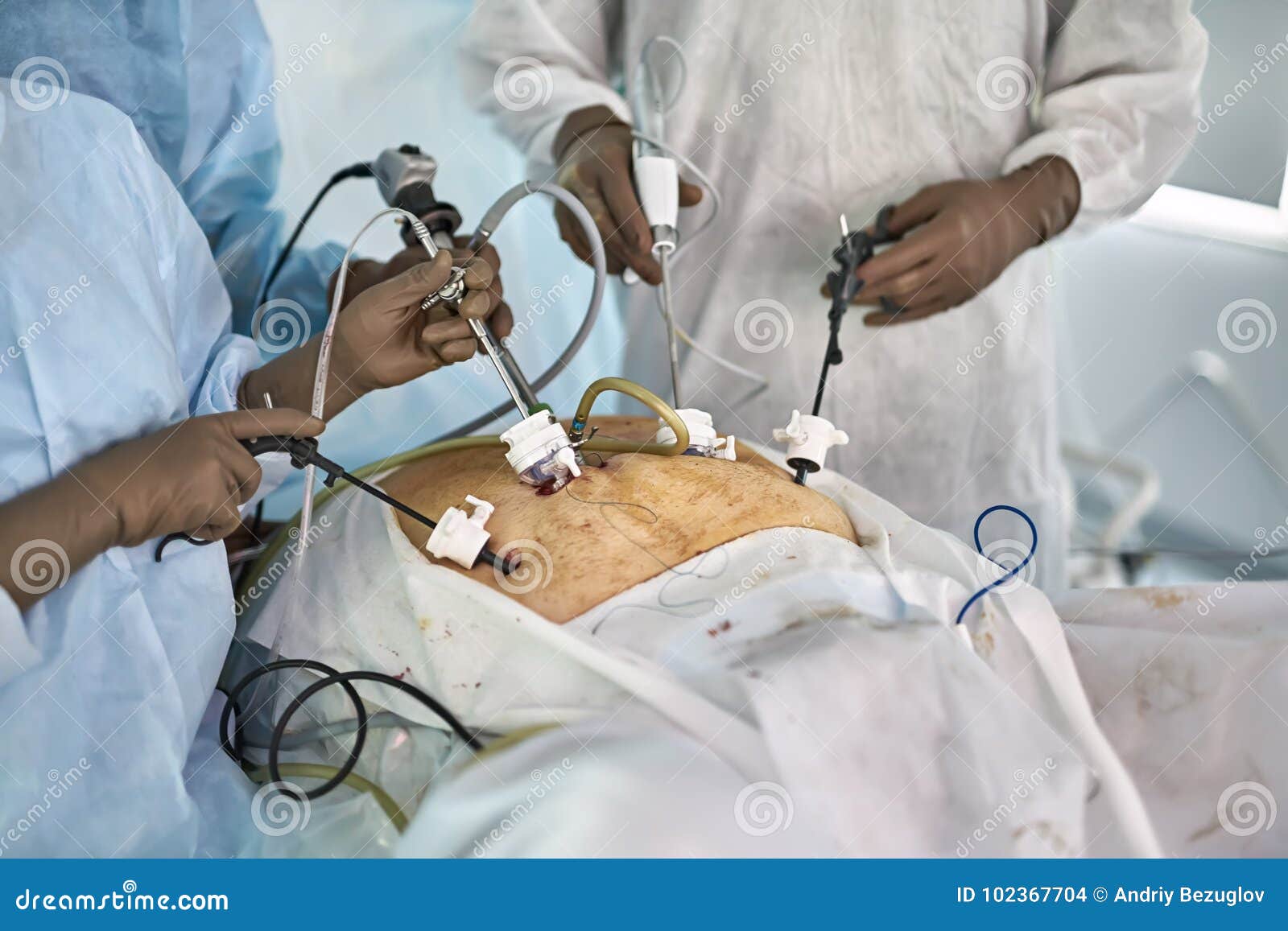 Laparoscopy Operation Process Stock Photo - Image of hospital, gloves ...
