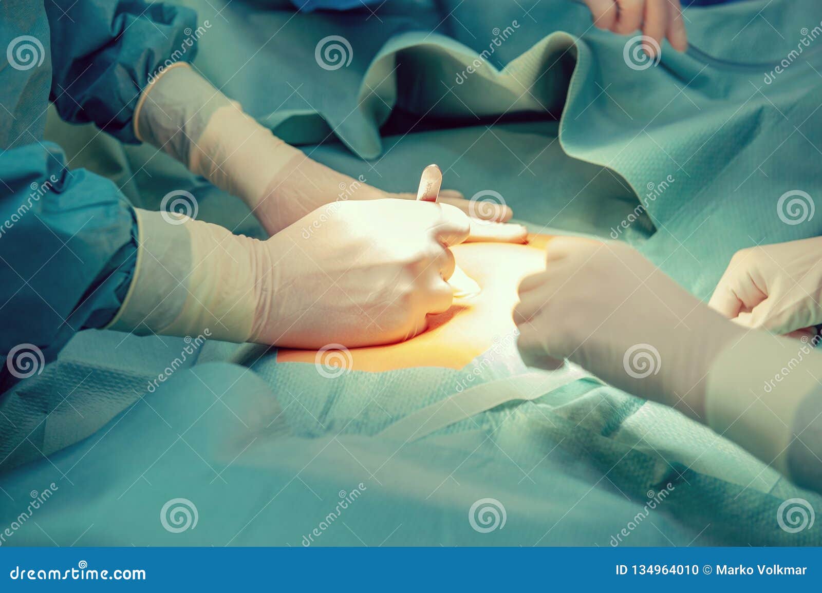 Surgeons Working on a Patient Stock Photo - Image of minimally ...