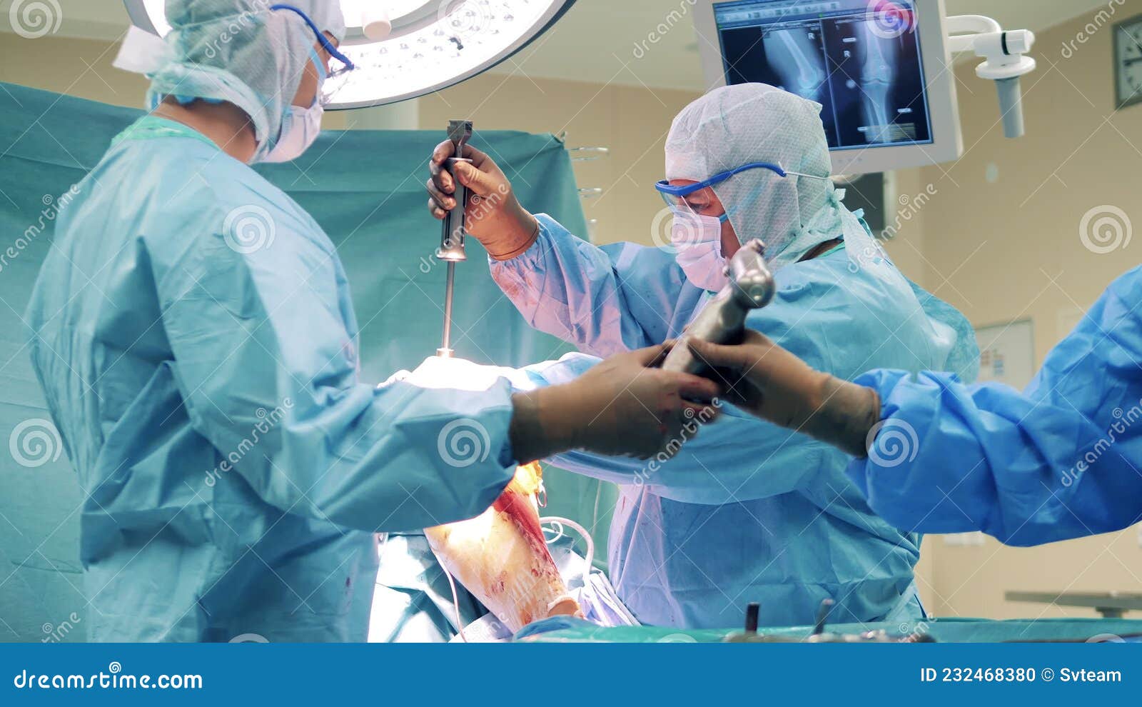 Surgeons are Working on Patient S Limb during Operation Stock Footage ...