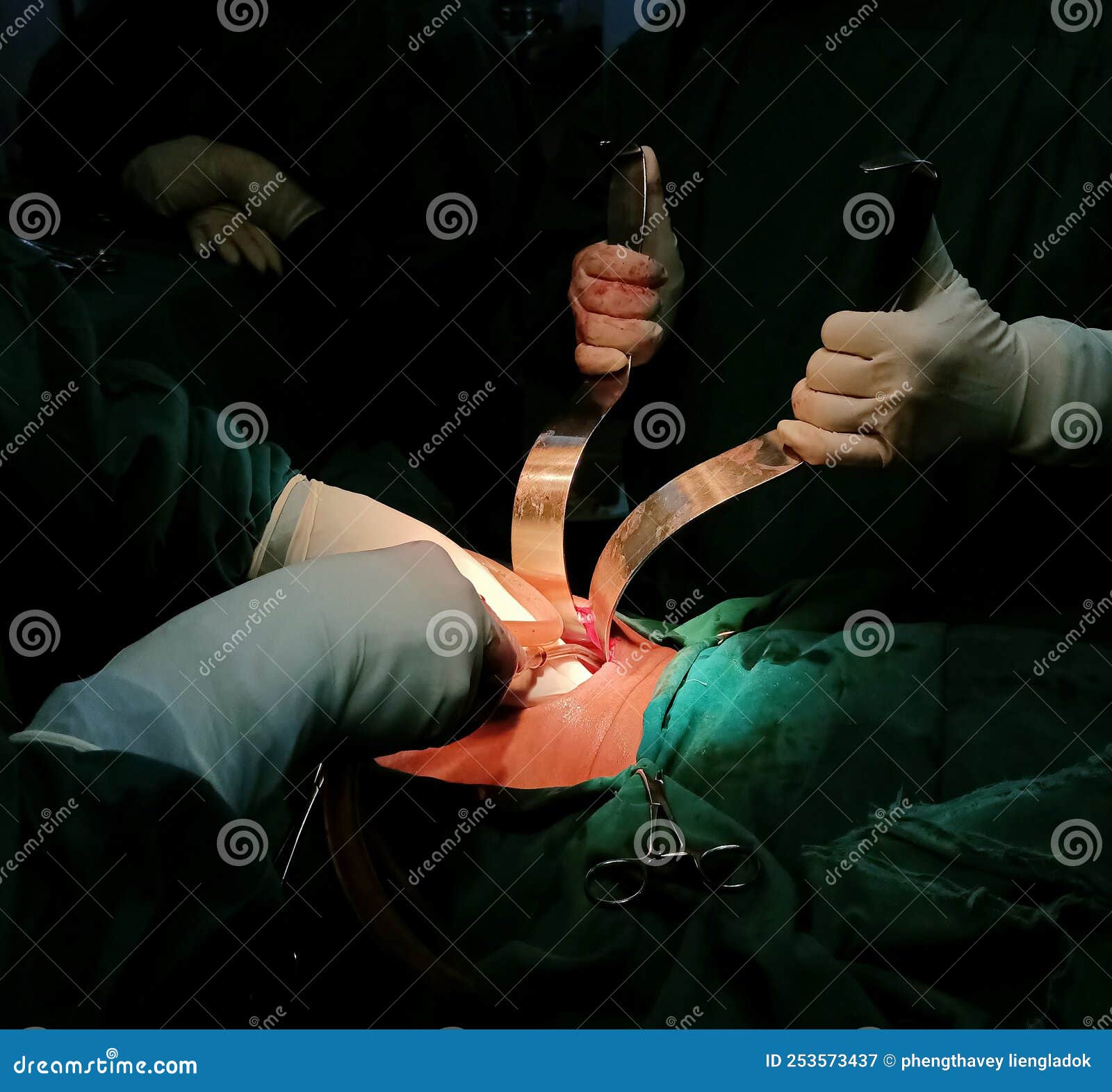 Surgery for Appendicitis, Inserting a Catheter Due To Appendicitis ...