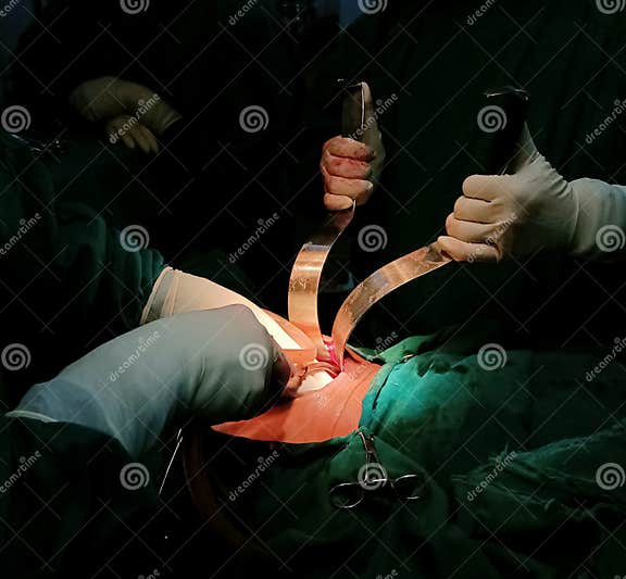 Surgery for Appendicitis, Inserting a Catheter Due To Appendicitis ...