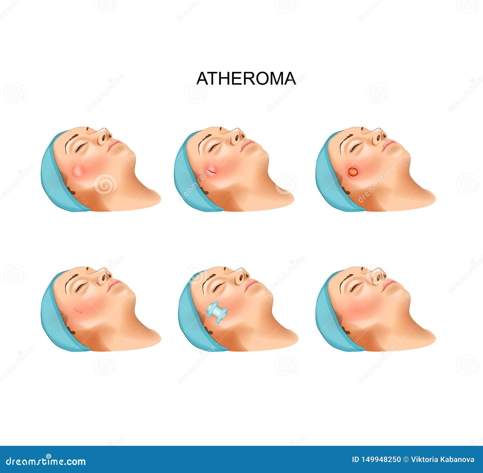 Surgery Of Benign Tumors Of Atheroma Royalty-Free Illustration ...