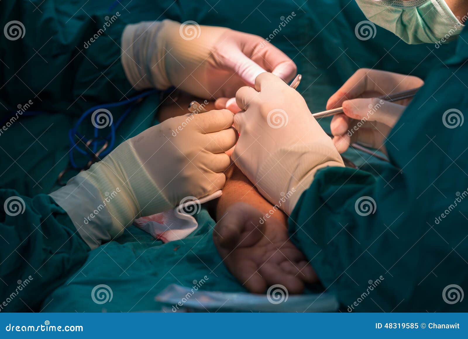 Surgery Team Operate Arteriovenous Fistula Stock Image - Image of ...