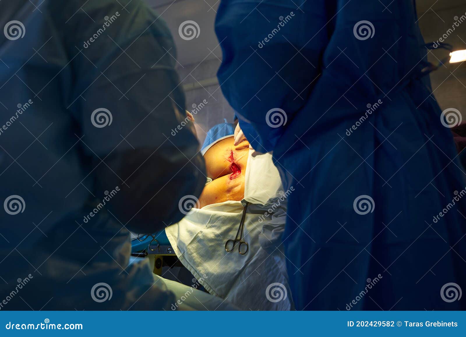 Surgery. a View between Surgeons, an Operating Wound Half-closed ...