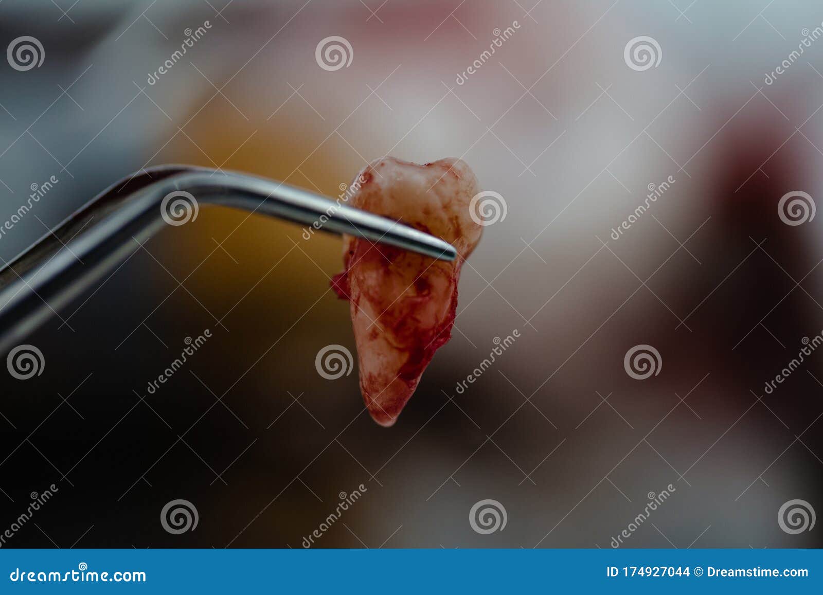 Surgical Extraction of Wisdom Tooth Stock Photo - Image of cafe, relax ...