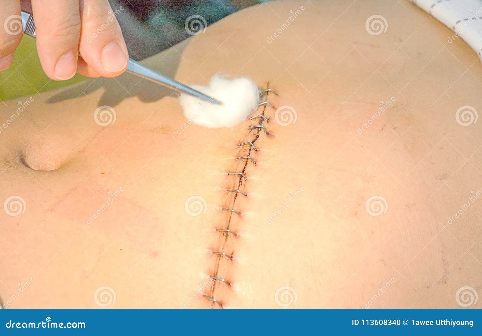 Surgical stapler abdominal stock photo. Image of operation - 113608340