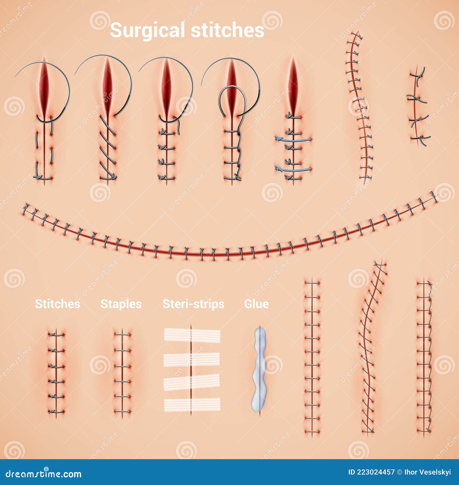 Surgical Stitches Infographic Set Stock Vector - Illustration of ...