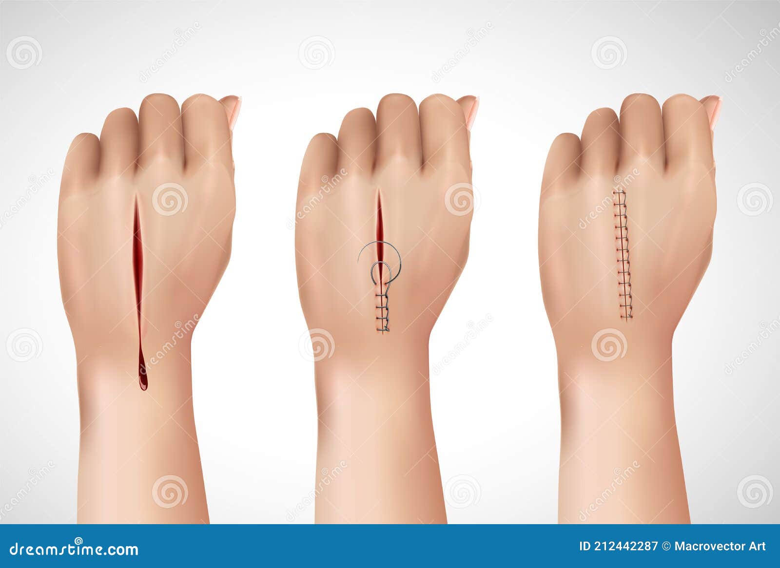 Stitching Of Surgical Incision Icon Vector Outline Illustration ...