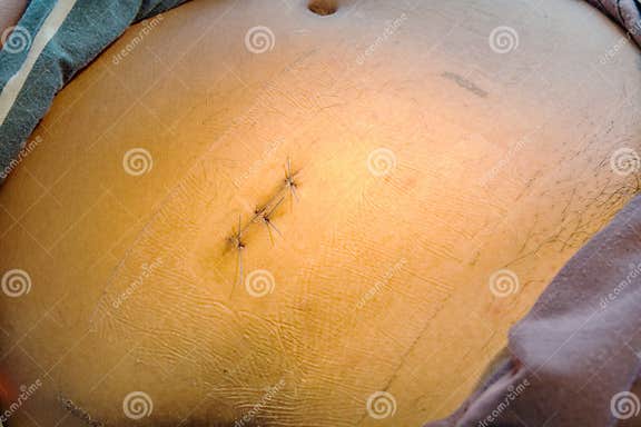 Surgical wound care stock photo. Image of care, patient - 129965850