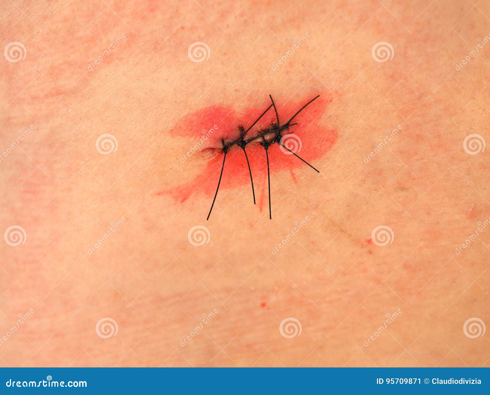 Surgical Wound with Stitches and Iodine Tincture Stock Image - Image of ...