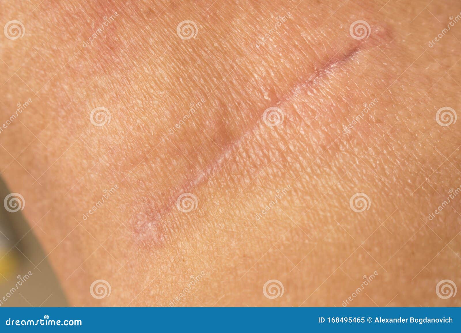 Suture after Surgery on the Human Neck. the Scar after the Surgery ...