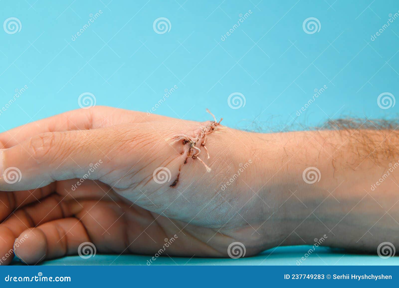Suture Wound on Hand from Dermatology Procedure Stock Image - Image of ...