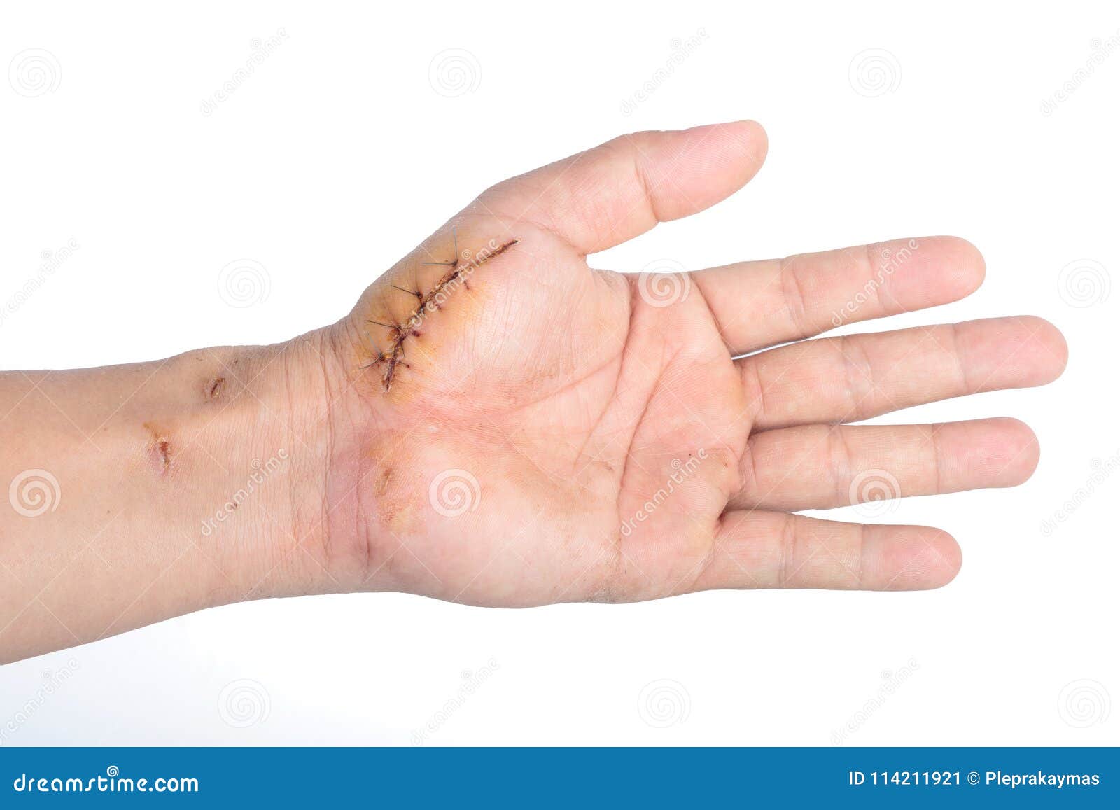 Suture Wound on Hand Isolate Stock Image - Image of healing, people ...