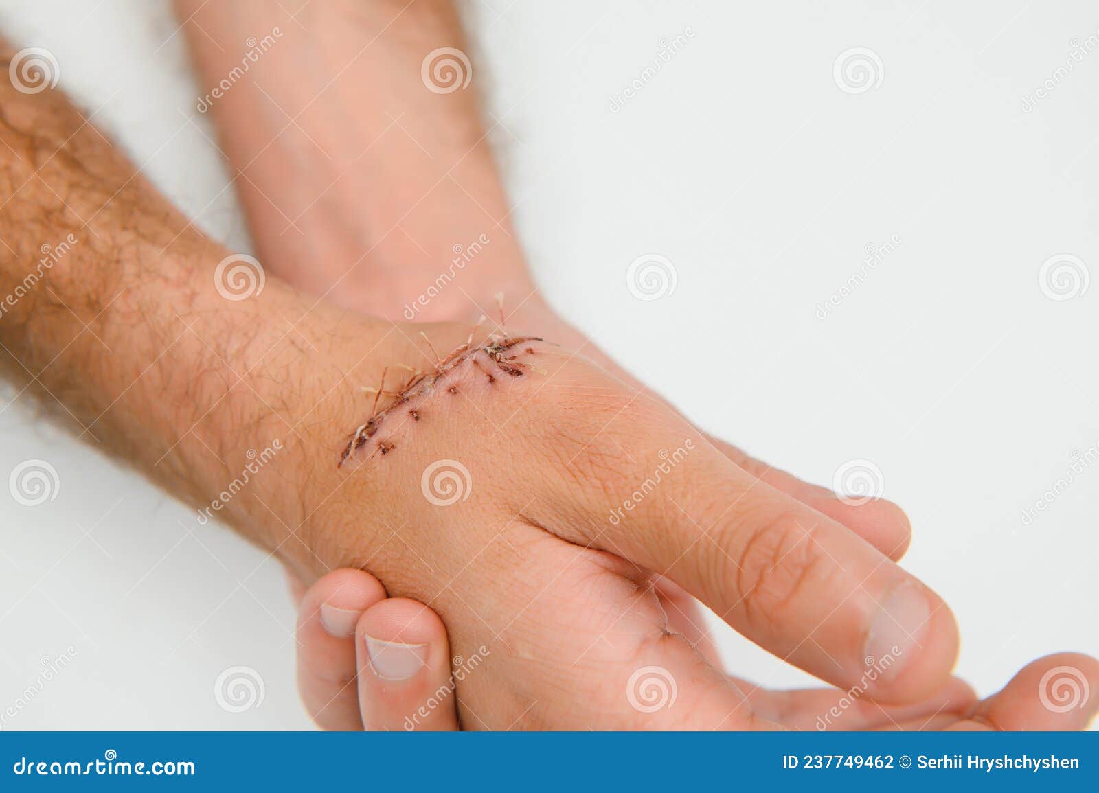 Suture Wound on Hand,Pain of Accident Concept Stock Photo - Image of ...