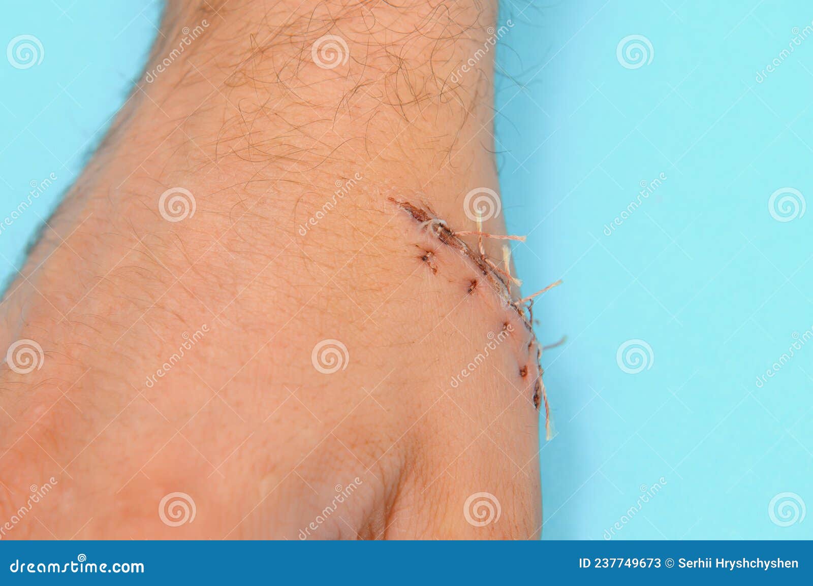 Suture Wound on Hand,Pain of Accident Concept Stock Image - Image of ...