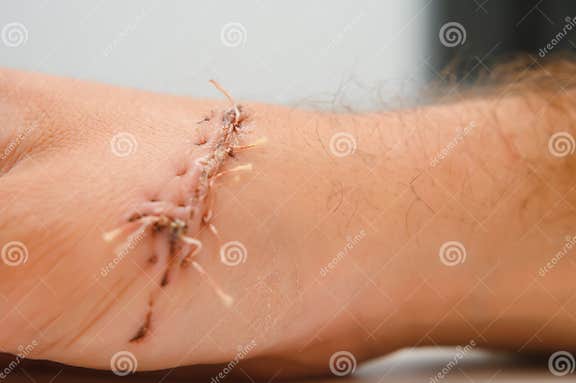 Suture Wound on Hand,Pain of Accident Concept Stock Photo - Image of ... Suture Wound on Hand,Pain of Accident Concept Stock Photo - Image of ...