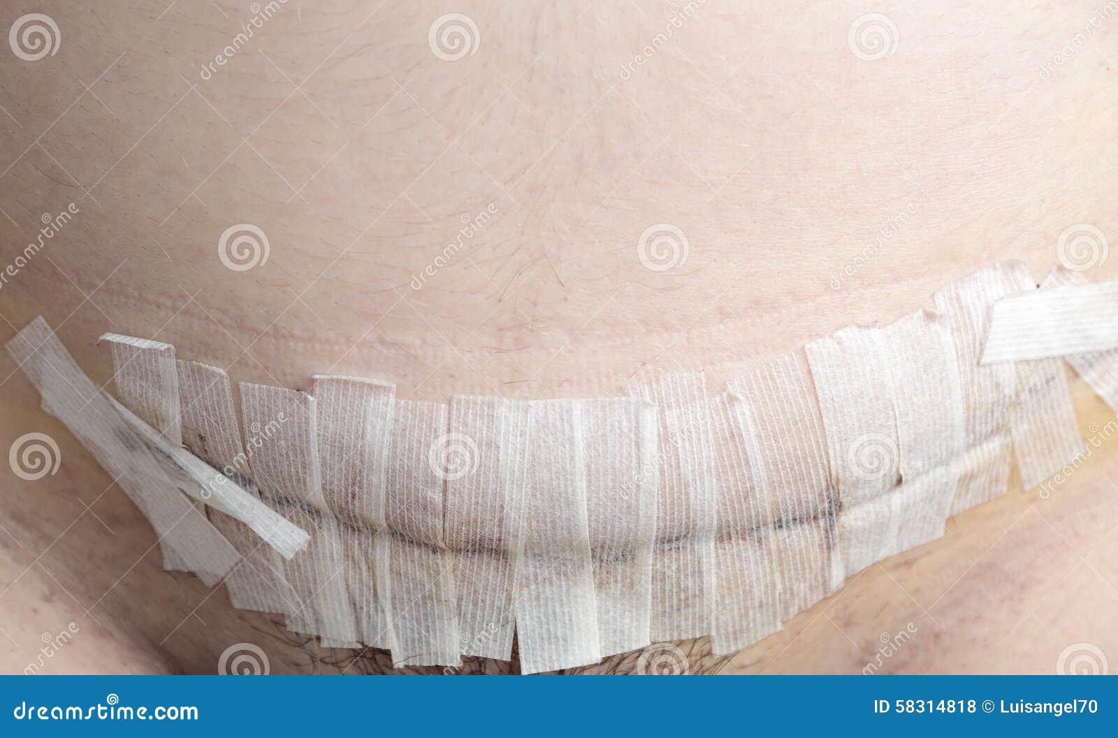 Suturing stitch stock photo. Image of skin, body, closeup - 58314818